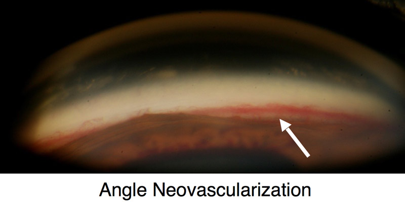 Types of Glaucoma and Their Impact on Vision | Cure Glaucoma Foundation