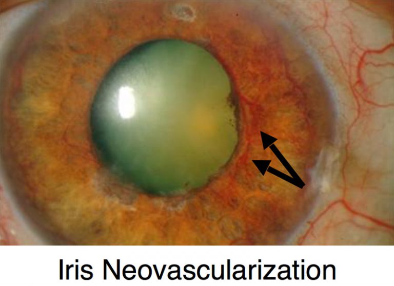 Types of Glaucoma – Cure Glaucoma Foundation