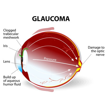 Breakthrough Glaucoma Research and Vision Restoration | Cure Glaucoma Foundation