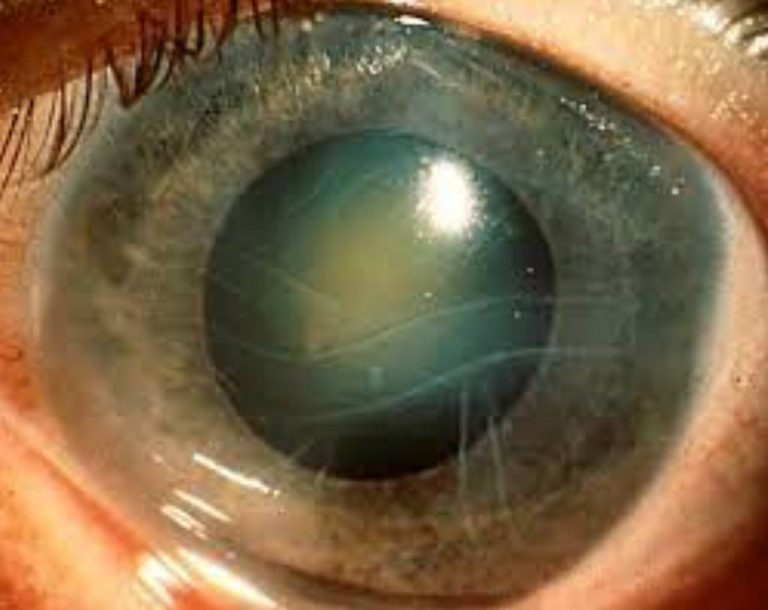 Childhood (Congenital) Glaucoma - Cure Glaucoma Foundation
