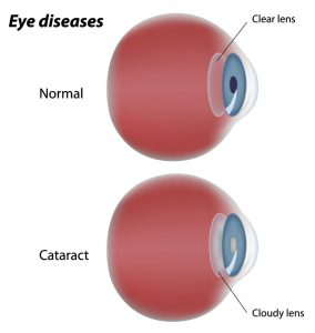 Cataract Surgery and Glaucoma | Cure Glaucoma Foundation