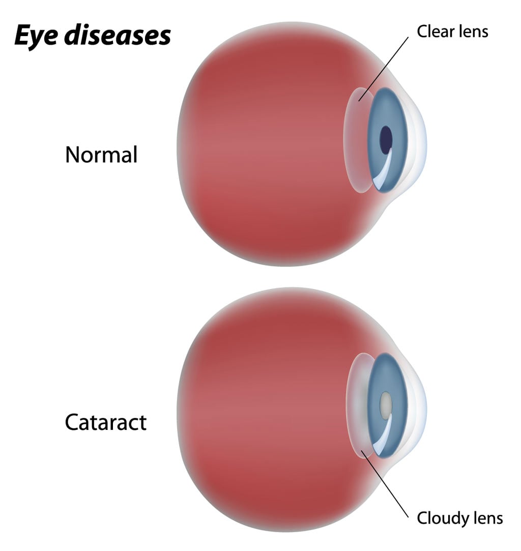 Cataract Surgery and Glaucoma - Cure Glaucoma Foundation