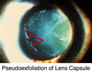 Types of Glaucoma and Their Impact on Vision | Cure Glaucoma Foundation