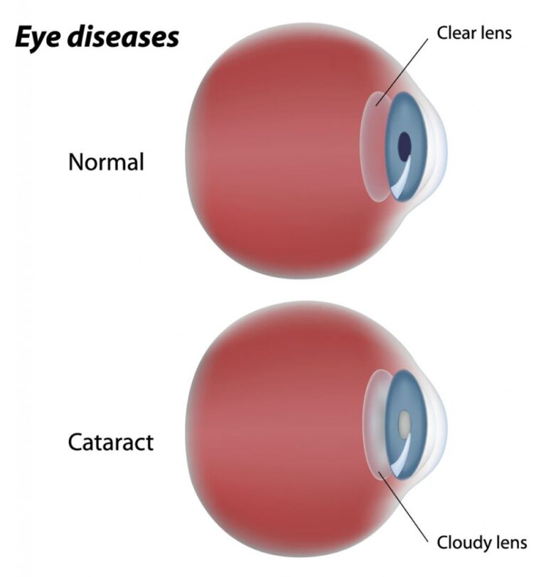 Cataract Surgery and Glaucoma | Cure Glaucoma Foundation