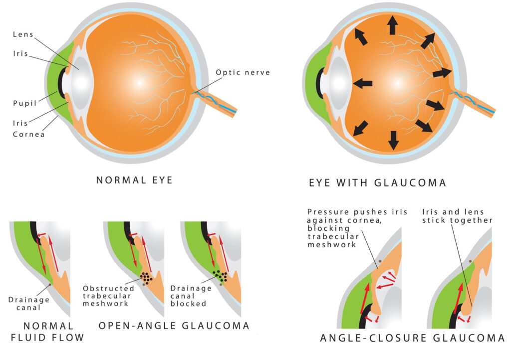 Types of Glaucoma and Their Impact on Vision | Cure Glaucoma Foundation