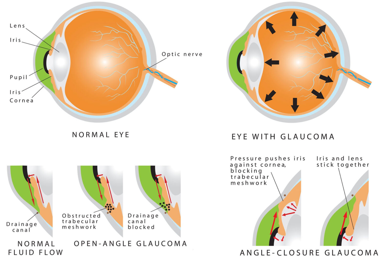 Types of Glaucoma and Their Impact on Vision | Cure Glaucoma Foundation
